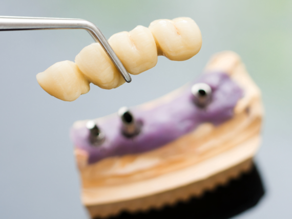 Gigi Jembatan (Dental Bridge) | Drg. Luh Putu Eka Sriwijayanti